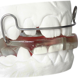 The Bionator Appliance for Pediatric Sleep - American Sleep and ...