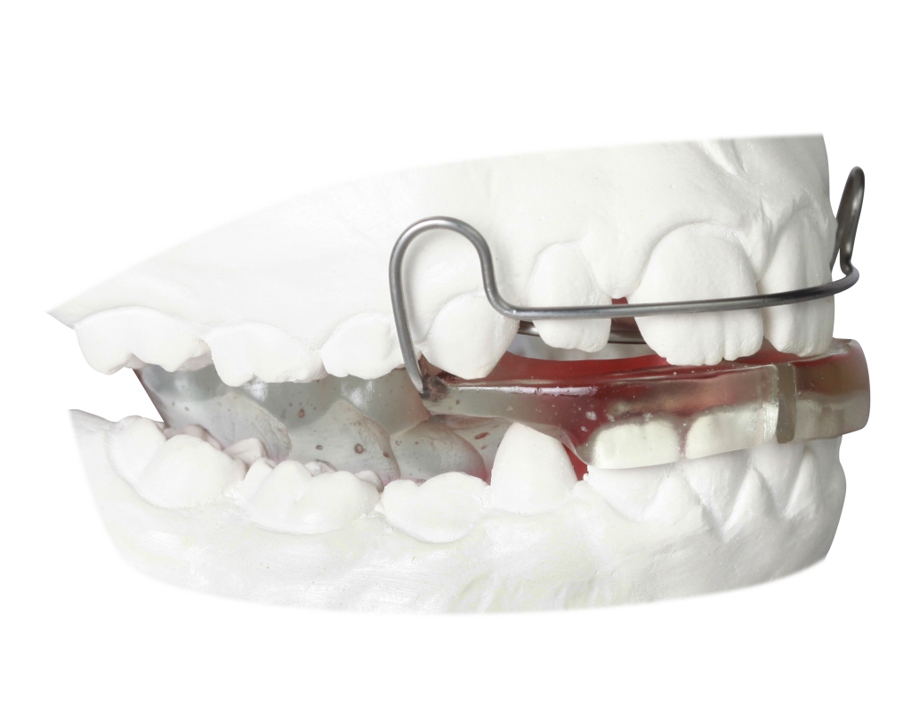 The Bionator Appliance for Pediatric Sleep - American Sleep and ...